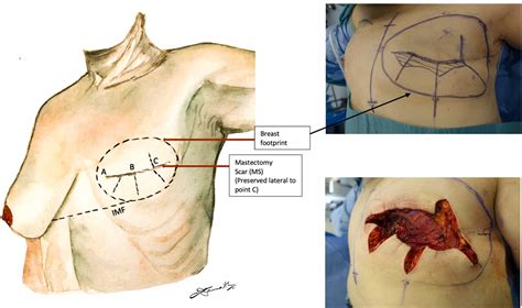 ‘rosebud Inset Of Diep Flap In Delayed Breast Reconstruction For
