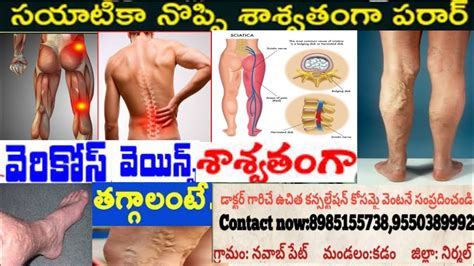 Severe Sciatica And Varicose Veins Cured With In 10 Days In Our
