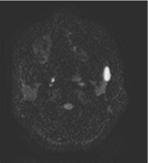Figure 4 From A Rare Case Of An Epidermoid Cyst Of The Parotid Gland
