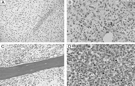 Transformation Of A Primitive Myxoid Mesenchymal Tumor Of In