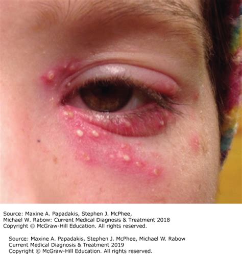 Hsv Eye How Viruses Can Affect Your Vision