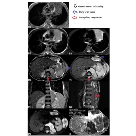 Malignant B3 Thymoma A 42 Year Old Female Patient Clinically