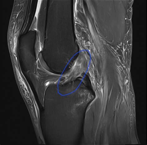 Acltear Acl Msk Clinicalradiologist Mriknee Dr Tahir Khan