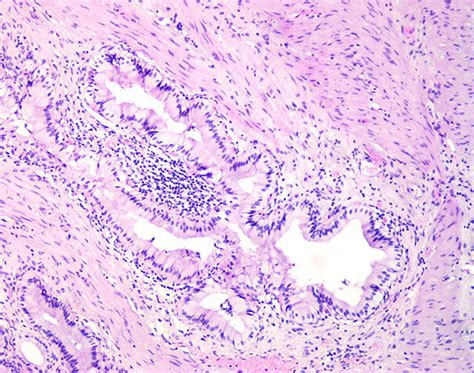 Sinus Of Rokitansky Ashoff In The Muscular Membrane Of The Gallbladder Download Scientific