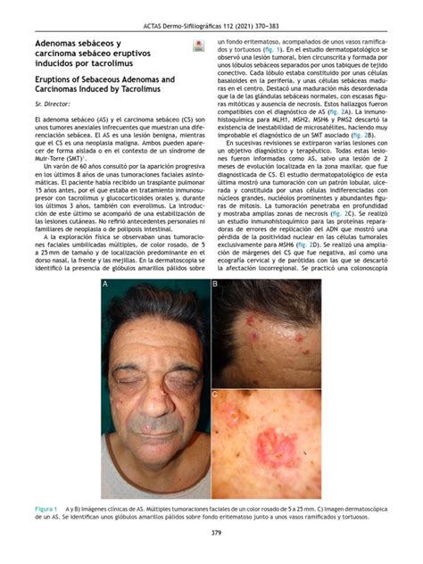 Adenoma Sebáceo Pdf Cáncer Especialidades Medicas