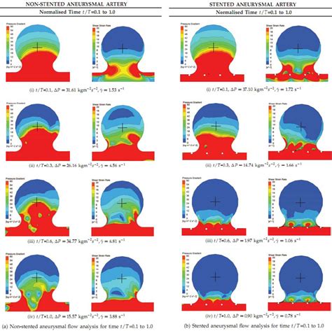 Streamline Tracing Of Aneurysmal Flow Download Scientific Diagram