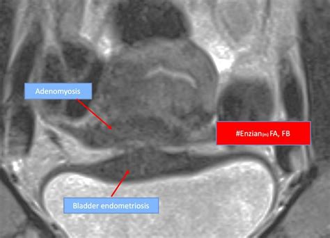 Enzian Classification A New Description Of Endometriosis For Invasive