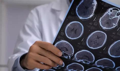 Esclerose Múltipla Especialista Esclarece Mitos E Verdades Sobre A