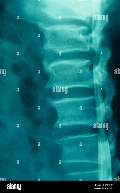 Lumbale Spinalkanalstenose Myelogramm Röntgen Der Wirbelsäule Durch
