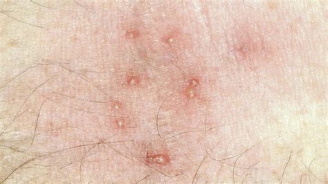 Can Dust Mites Leave Bite Marks At Alana Walden Blog