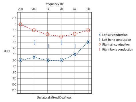Hearing Loss Enteducationswansea
