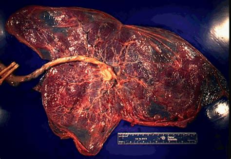 Placenta Membranacea