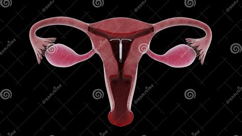 Biomedical Illustration Of An Intrauterine Device In Position Inside The Female Uterus Stock