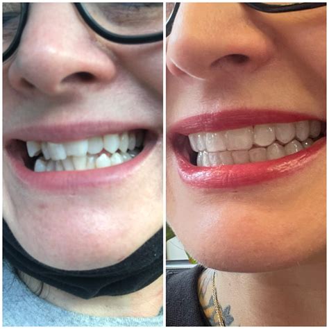 Months In Traditional Braces R Braces