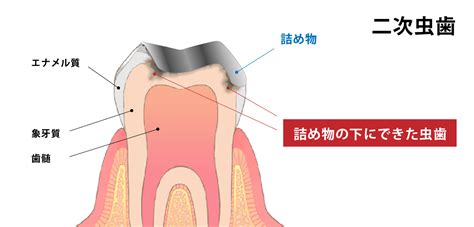 成人からの虫歯に要注意 新宿ではじめる歯周病治療と予防｜『歯科の予防はじめる