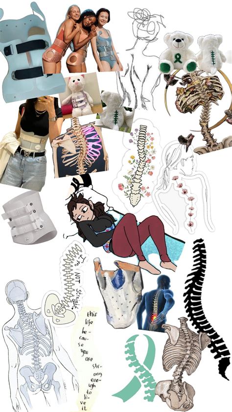 Pin On Spinal Fusion