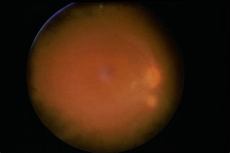Necrotizing Retinitis Retina Image Bank