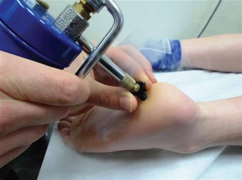 Liquid Nitrogen On Warts