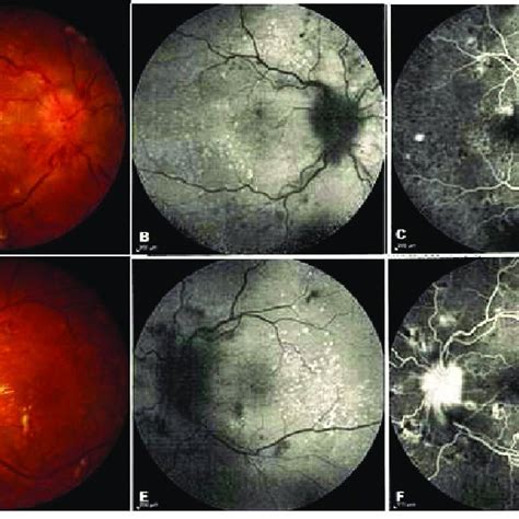 A A Fundus Retinography Of Both Eyes Shows Bilateral Cotton Wool