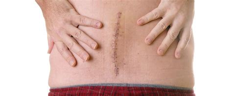 How Long Does Pain Last After Decompression Surgery