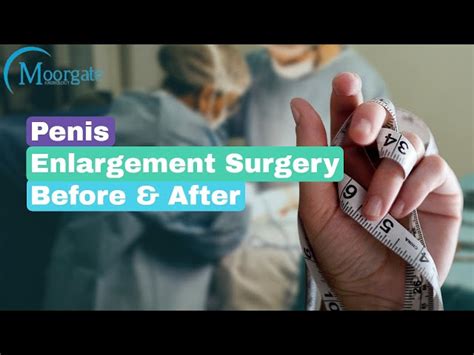 Before And After Pictures Of Penis Enlargement Surgery Cheap Sale