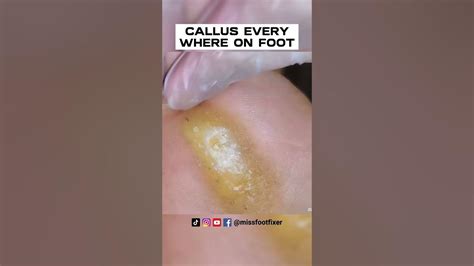 Callus Everywhere On Foot 2023 Never Ending Callus Scraping By Foot