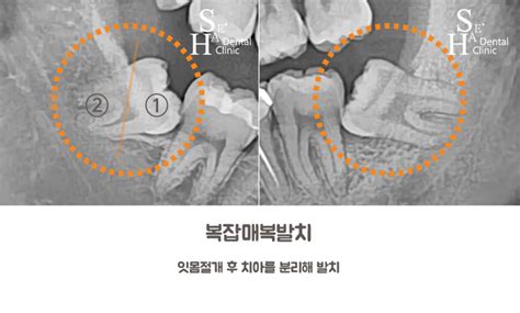사랑니발치종류 알아보자 단순 복잡 완전매복 네이버 블로그