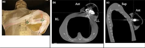The Breast Phantom P2 A 3d Printed Tissue‐equivalent Breast With In