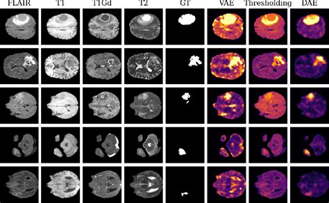Figure 3 From Denoising Autoencoders For Unsupervised Anomaly Detection In Brain Mri Semantic