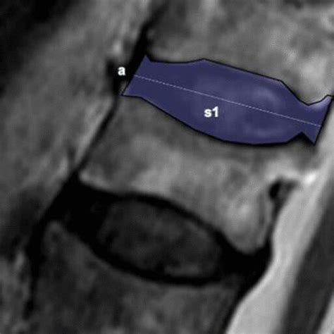 Comparison Of Pre And Post Operative Modified Pfirrmann Grading System Download Scientific