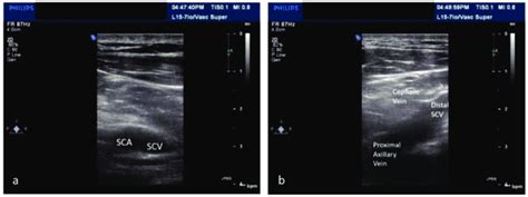 Ultrasound Of The Subclavian Vein In The Infraclavicular Approach A
