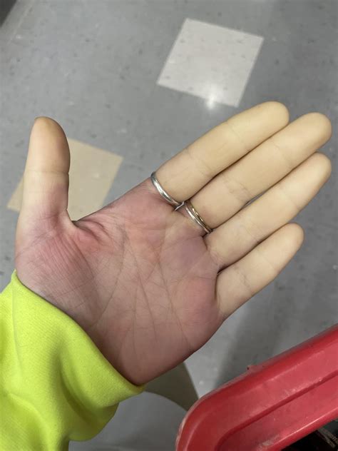 I Have Nodes R Raynauds