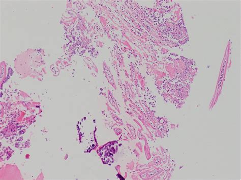 Photomicrographs Of A Hande Stained Section Of The Mass Showing Fibrous