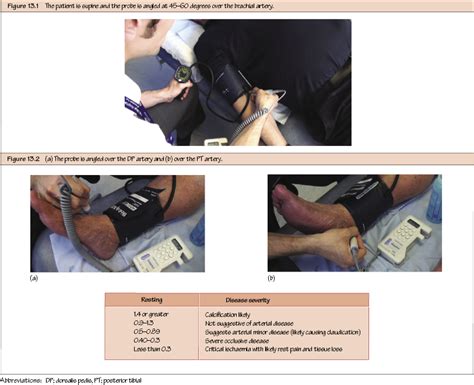 Ankle Brachial Pressure Index Measurement Thoracic Key