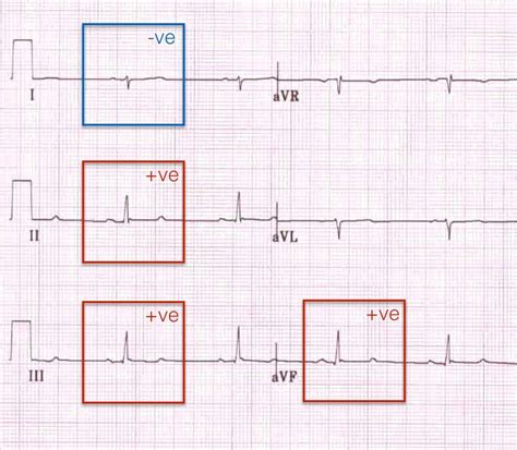 Ecg Axis Deviation Chart EKG Anatomy Axis From Life In The Fast Lane