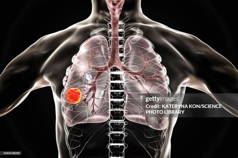 Lung Cancer Illustration High Res Vector Graphic Getty Images