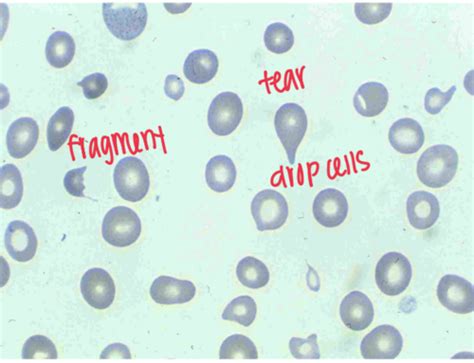 Md Lb 4300 Hematology Lecture 017 Hypoproliferative Disorders Flashcards Quizlet