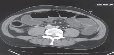 Single Roundworm Causing Intestinal Obstruction Rare Case W
