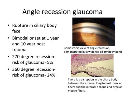 Secondary Glaucoma Finalpptx