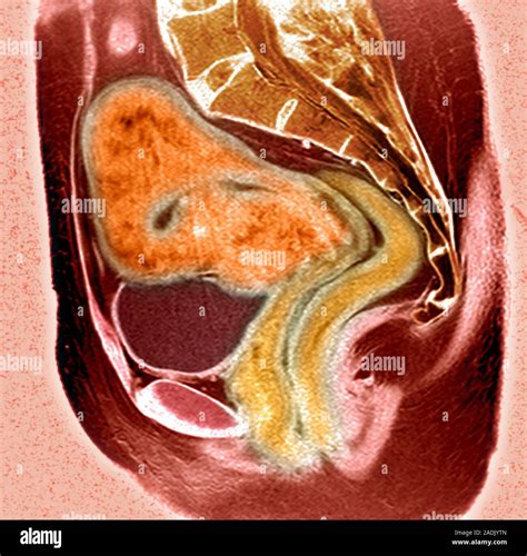 Uterine Fibroid Coloured Magnetic Resonance Imaging Mri Scan Of A Sagittal Sideways Section