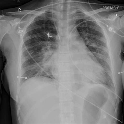 Chest X Ray Showing Bilateral Patchy Infiltrates Download Scientific
