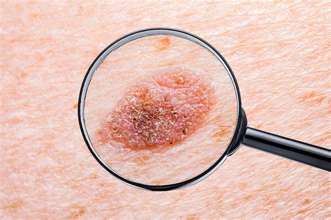 Todo Lo Que Tienes Que Saber Sobre El Melanoma Signos Y Síntomas Para