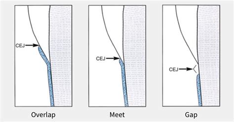 Three Keys To Ceramic Dental Adhesion Enamel Dentin And Cementum