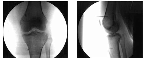 Fluoroscopic View Of The Targets Of Genicular Rfa Showing The Needle
