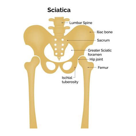 Sciatica Science Design Illustration Diagram 48042334 Vector Art At