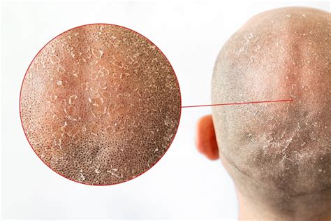 Seborrea Dermatitis Seborreica Del Cuero Cabelludo