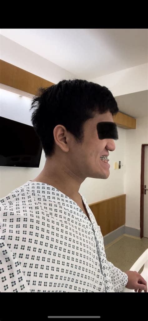 Should I Proceed With An Underbite Jaw Surgery 24 Yo Male Rjawsurgery