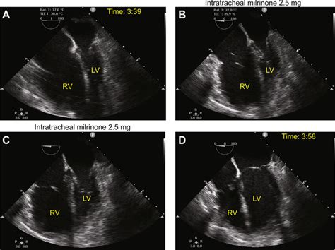 A D A Transesophageal Echocardiography Midesophageal 0 Degree View