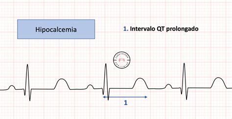 Hipocalcemia En Ecg 2025