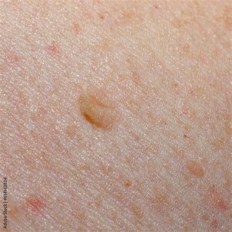 Nevus Or Mole On The Human Body Close Up Skin Cancer Keratosis Or
